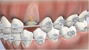 My baby canine tooth hasn't fallen out. - Cosmetic Dentistry Blog